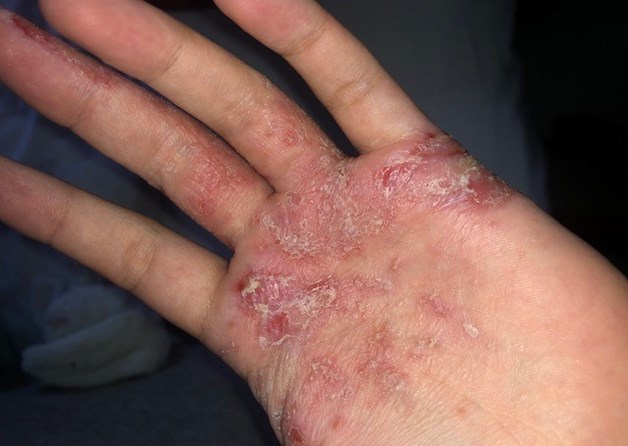 Palmoplantar pustulosis - Your Stories - Psoriasis Association