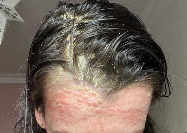 Guttate - Your Stories - Psoriasis Association
